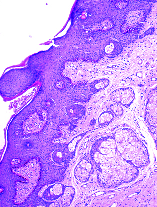 Sebaceous Gland Hyperplasia Scrotum