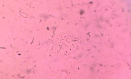 Grade 3 of ferning pattern-Ferns are little and incompletely formed ...