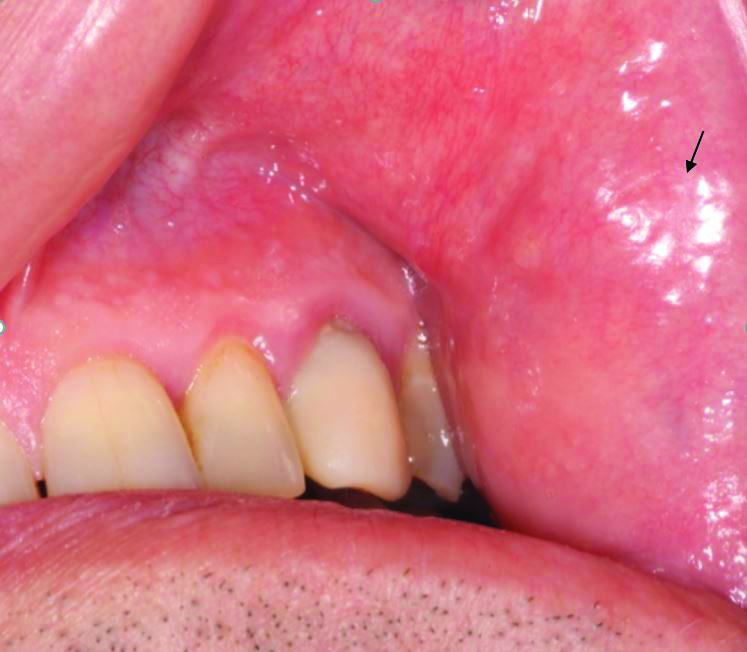 Minor Salivary Glands