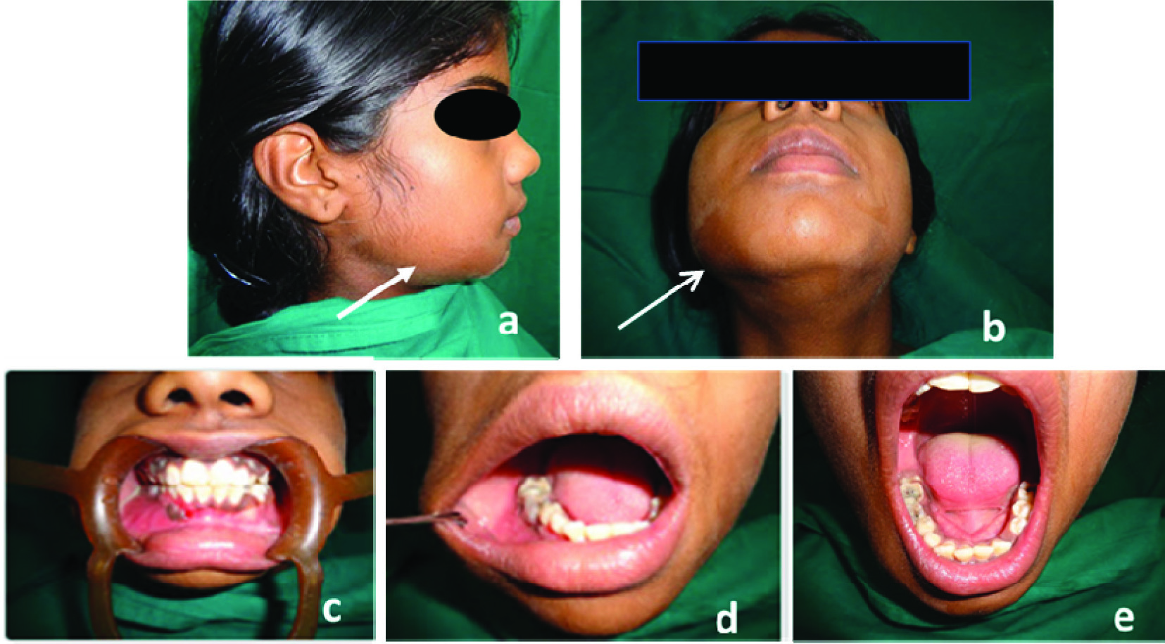 Odontogenic Keratocyst Clinical Features JCDR Dentigerous Cyst,