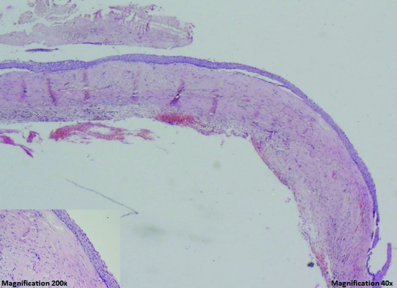 Eruption Cyst Histology Cyst Of Jaw