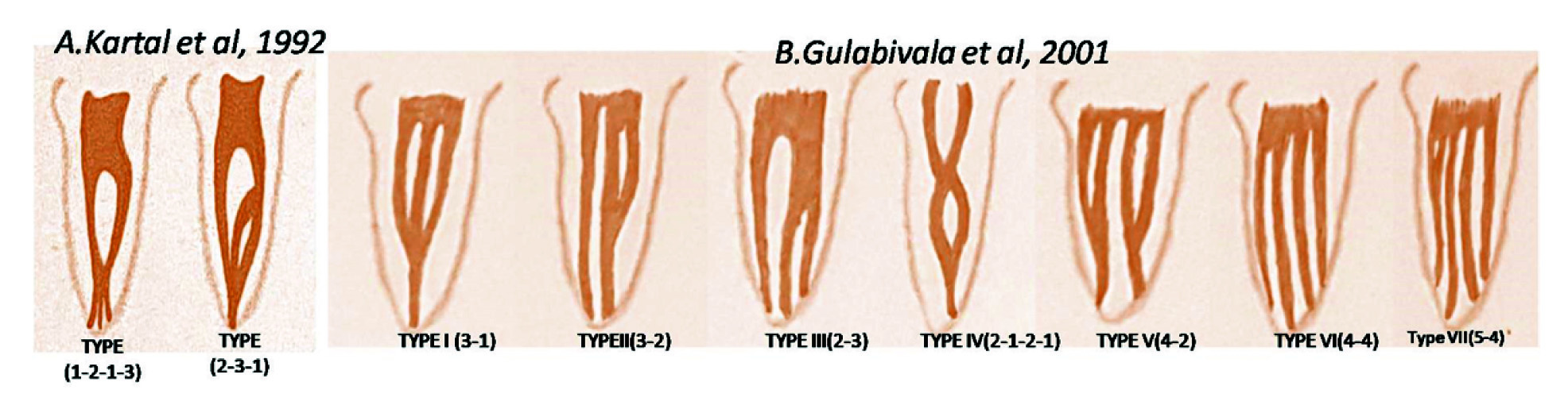 Root canal configuration (1-2-1-3): One canal starts from pulp chamber ...