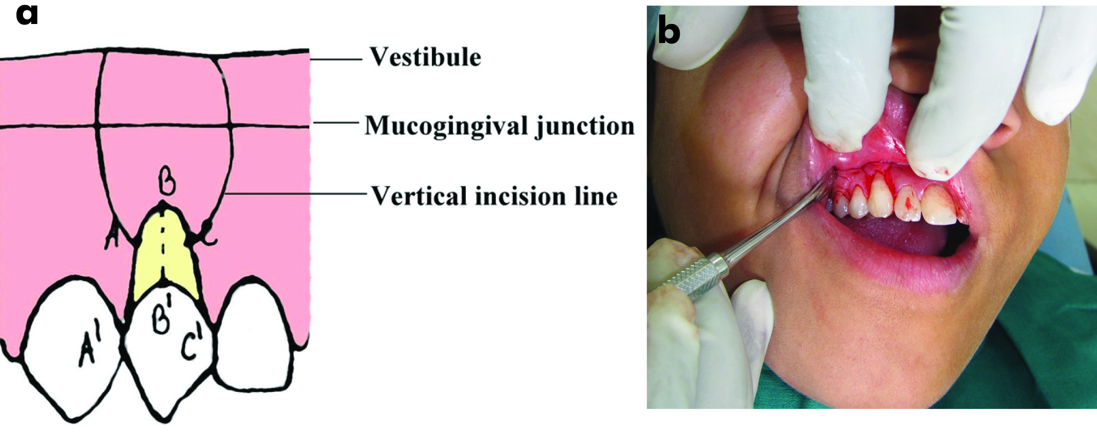 Mucogingival Junction