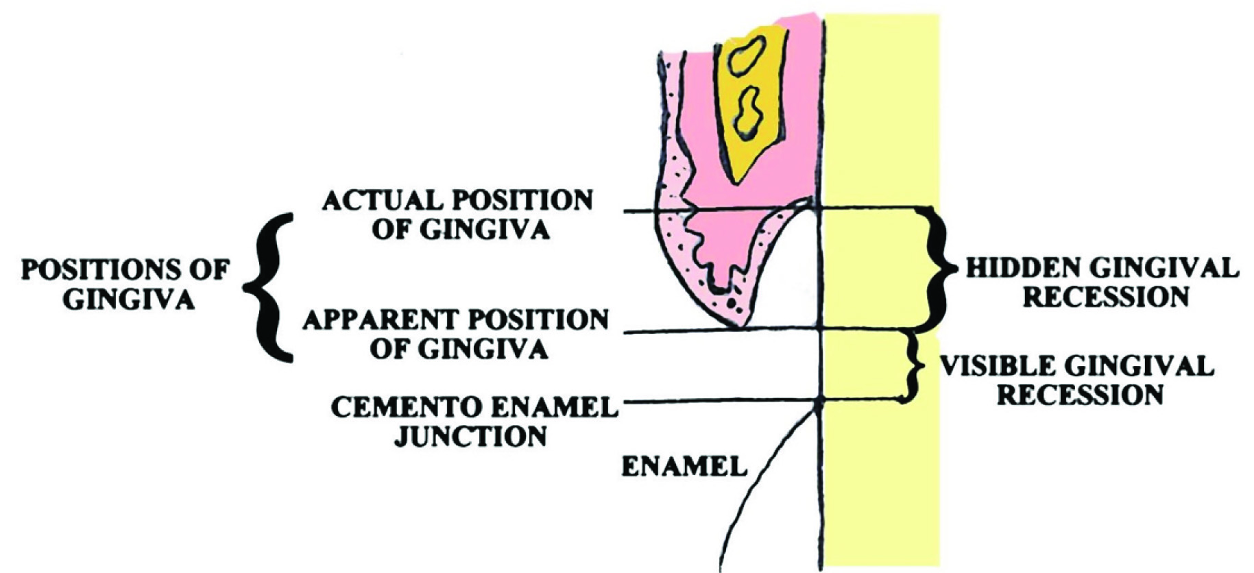 Gingival Recession Diagram