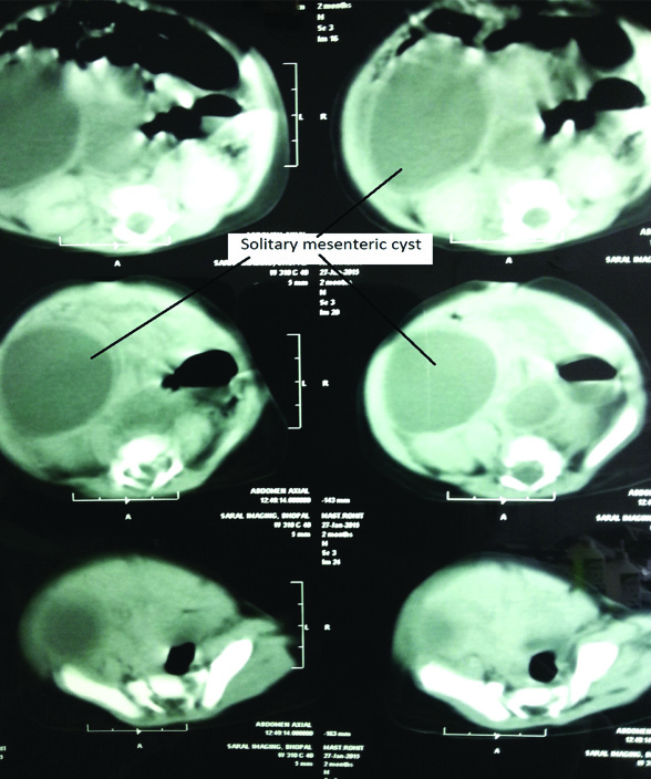 CT scan of abdomen showing multi cystic mesenteric cysts of size 11.2x5 ...