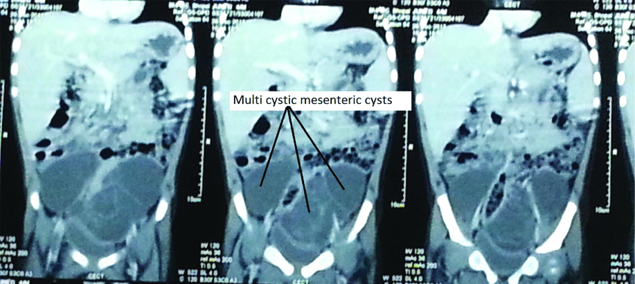 CT scan of abdomen showing solitary mesenteric cyst of size 10.2 x 6.9 ...