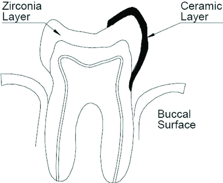 Design III of zirconia-ceramic interface.