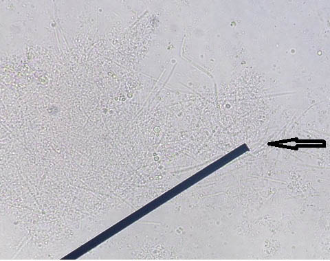 a) KOH mount showing septate, branching fungal hyphae (400x); b) KOH ...