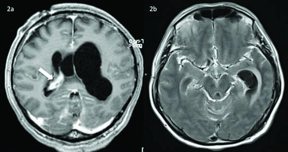 Basal Cisterns Mri