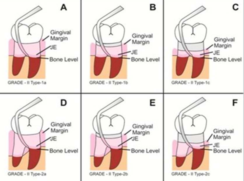 Gingival Recession Classification