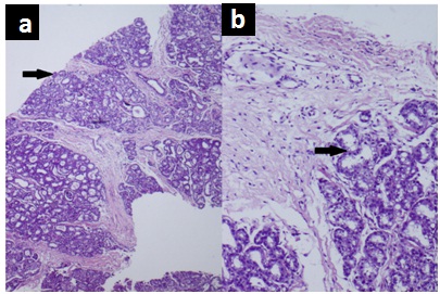 a) Section shows hyperplastic breast lobules with interspersed thick ...