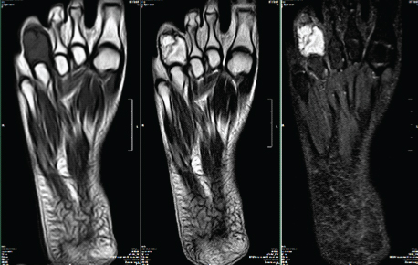 MRI showing well-defined expansile lesion (hypointense T1/Hyperintense ...