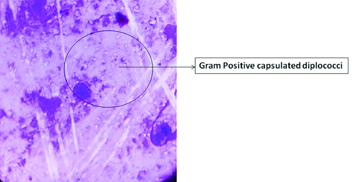 Streptococcus Pneumoniae Gram Stain Csf