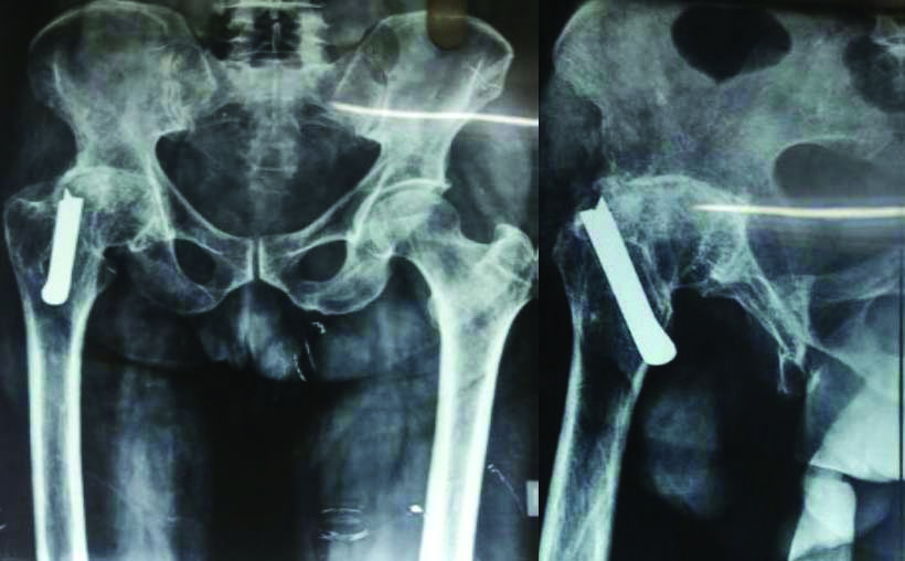 Gamma Nail Hip Surgery - Nail Ftempo