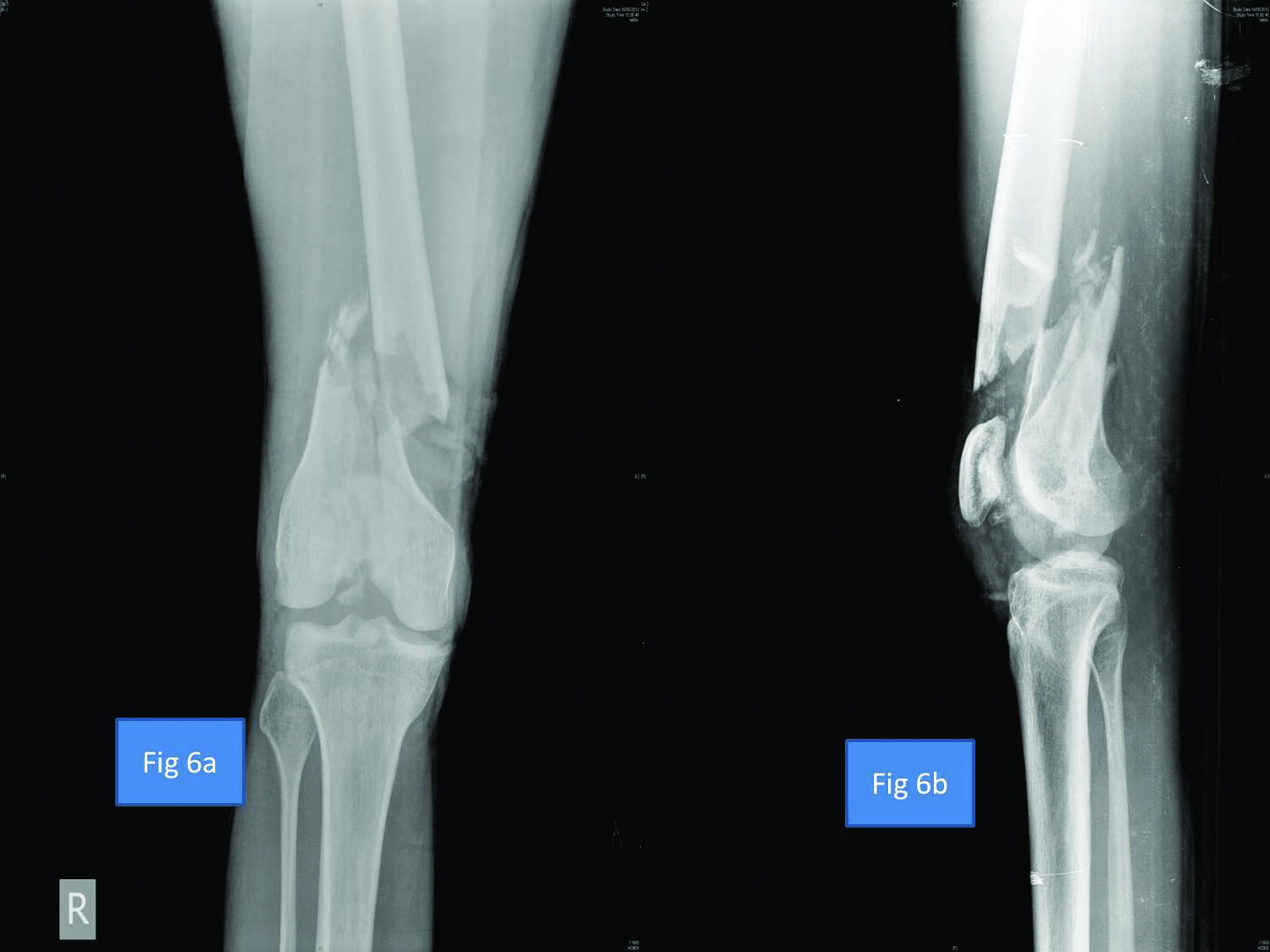 Fixation of distal femur with plate and PMMA antibiotic beads for ...