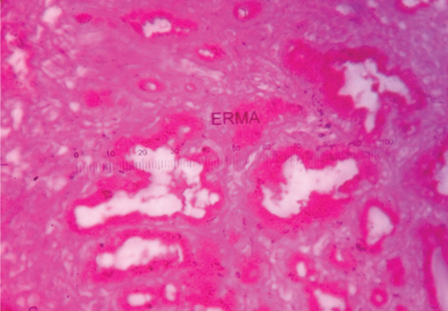 Alcian Blue positive mucin in glands of pyloric metaplasia of gall ...