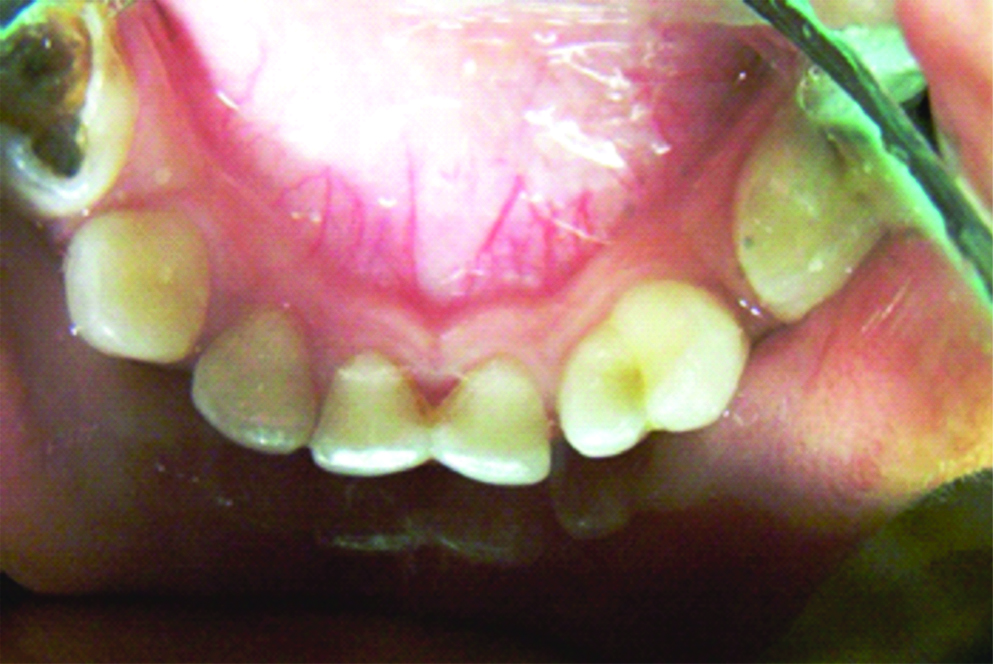 Periapical radiograph [ Table/Fig-3 ] of the fused tooth revealed bifid ...