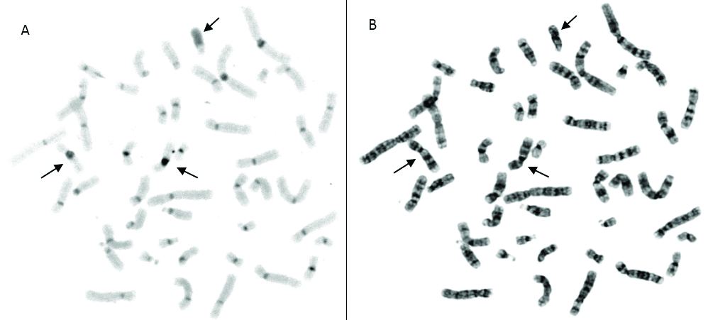 It was found that the proband who carried the 9qh+ and Yqh+ variants ...