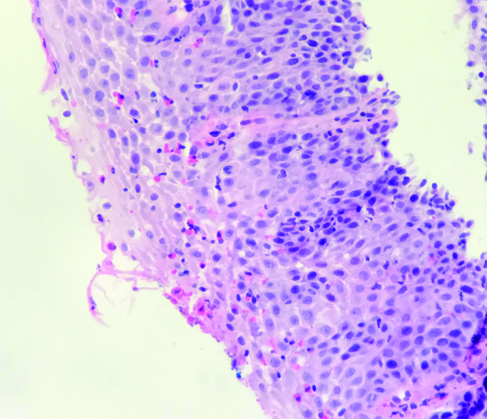 Photomicrograph of biopsy (from the first patient) obtained with jumbo ...