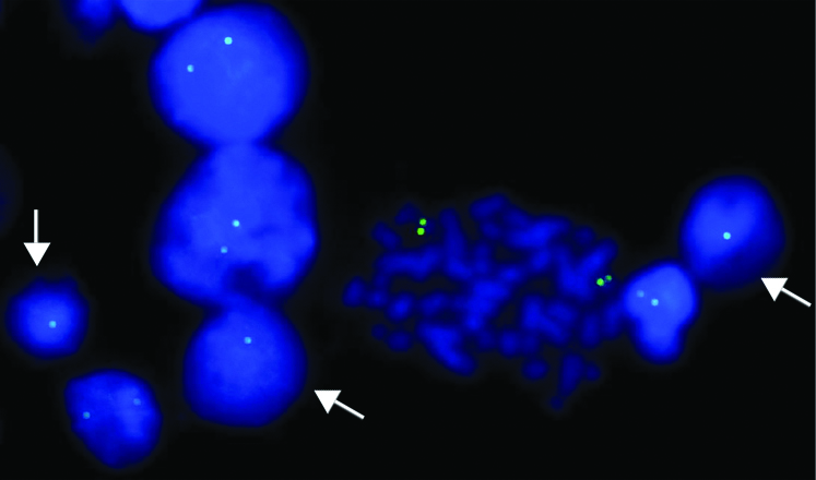 FISH image using 22q11.2 locus specific probe (labelled with Cy3) on ...
