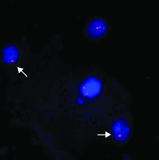FISH image using 22q11.2 locus specific probe (labelled with Cy3) on ...