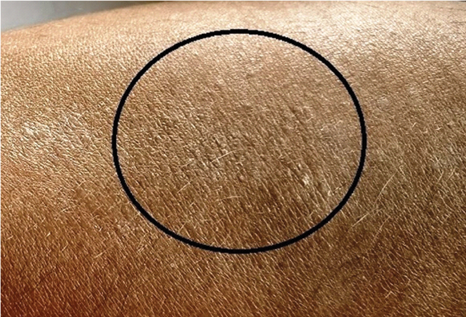 PMLE: Multiple skin coloured micropapules on the dorsal aspect of forearm.