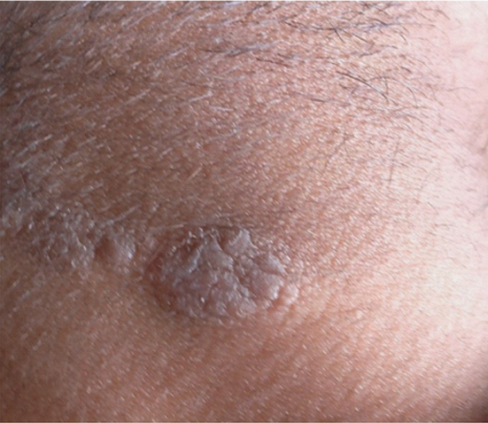 Mild Polymorphic Light Eruption