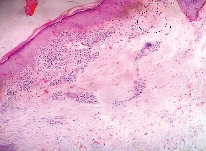 Psoriasiform pattern: Marked hyperkeratosis along with mild spongiosis ...