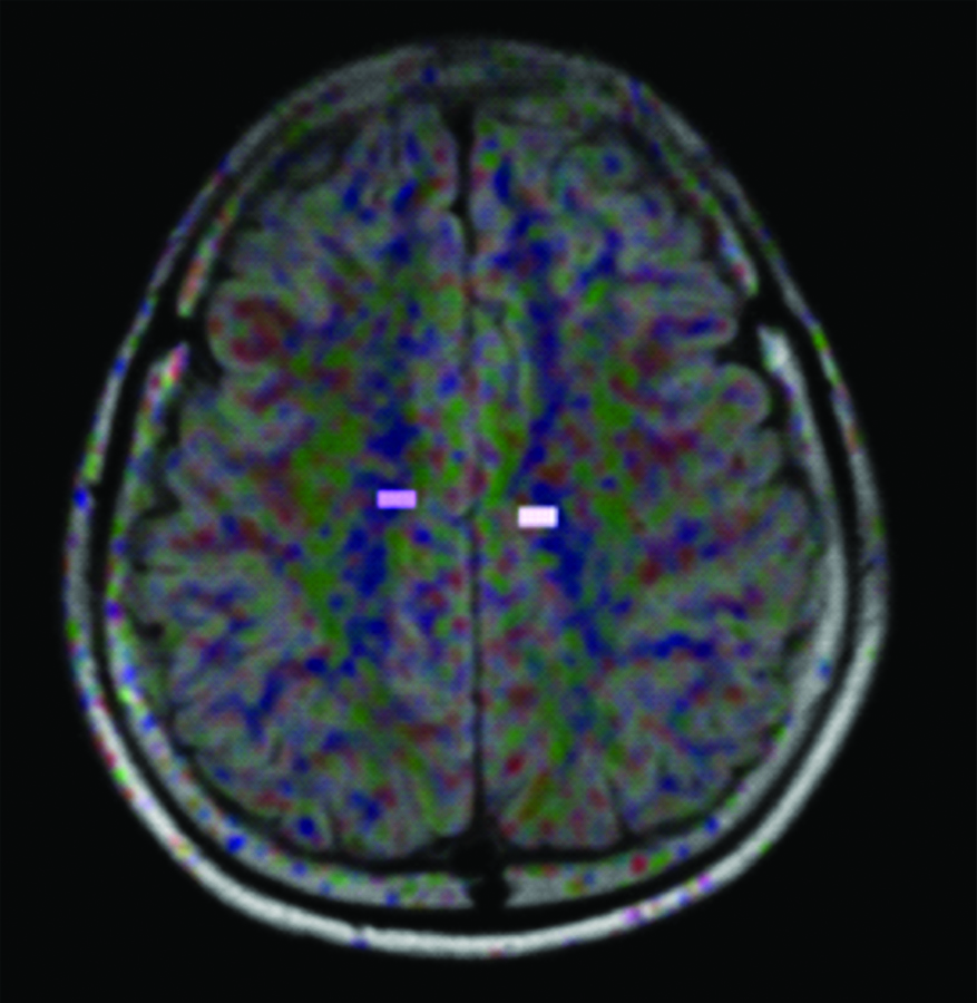 ROI placement at the right and left pons.