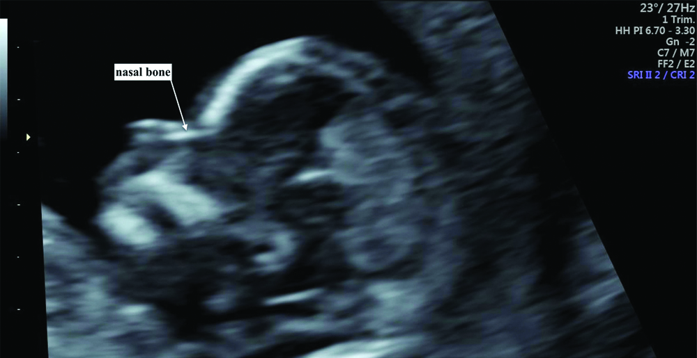 Nasal Bone Ultrasound Genetic Sonography: 3D US