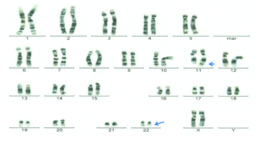 G banded karyogram (UID:2) showing the der(22)t(11;22)(q23;q11.2 ...
