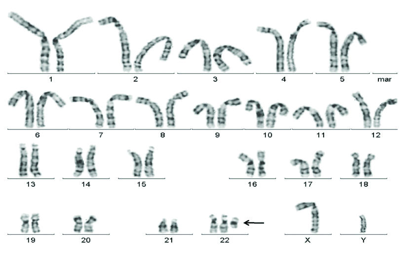 Arrow indicates the additional der(22)t(11;22)(q23;q11.2) chromosome in ...