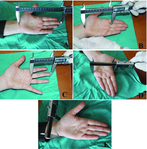 Hand measurements: (a) hand length; (b) palmar length; (c) third finger ...