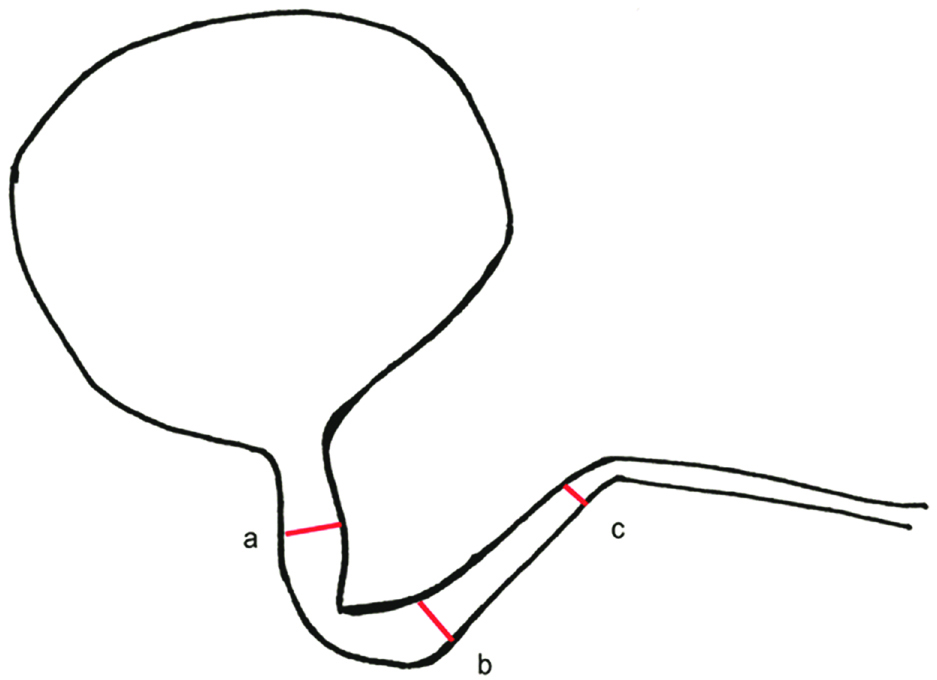 Anterior Urethral Valves