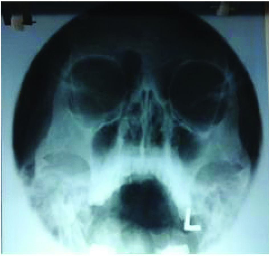 Paranasal Sinuses Radiograph Showing Hypoplastic Maxillary