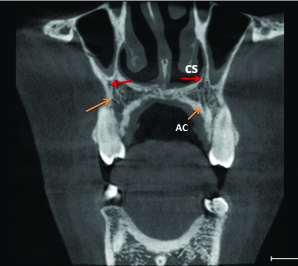 Coronal section at the level of frist premolar depicting the path of ...