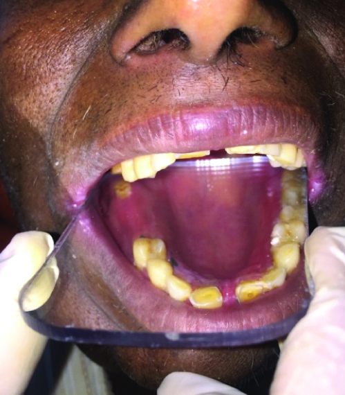 Intraoral view of patient showing the occlusion.