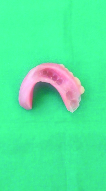 Relined mandibular overlay denture.