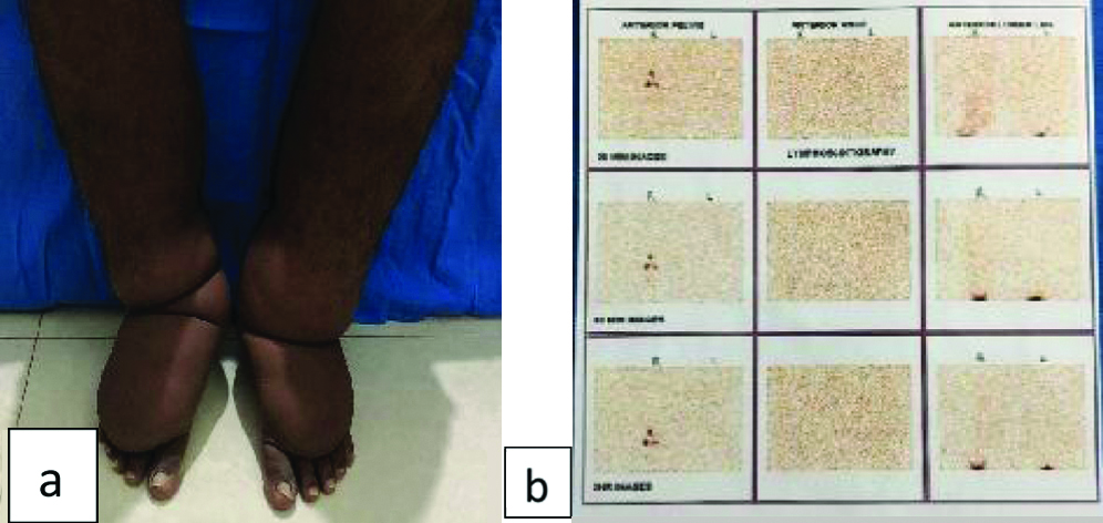 (a) Clinical picture demonstrating elephantiasis of leg with medicine ...