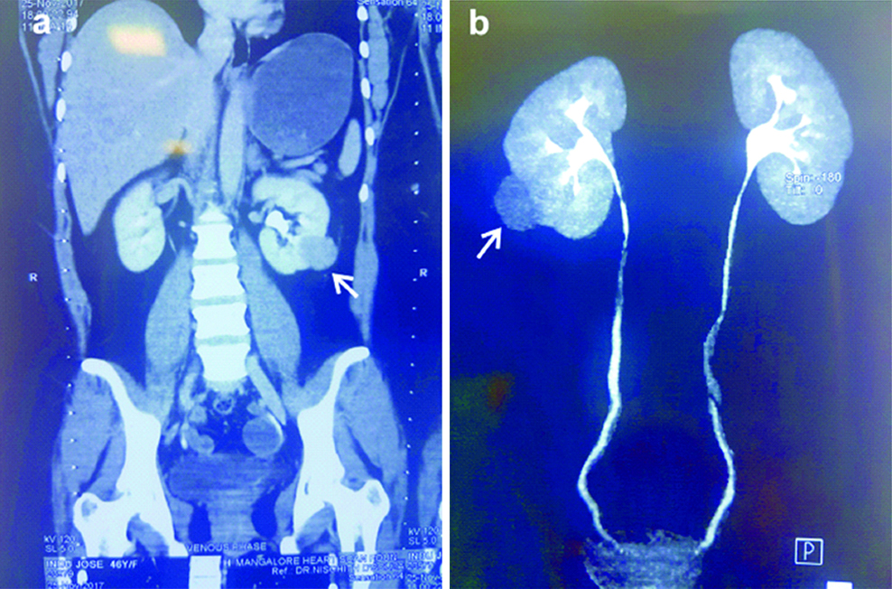 (a and b) Contrast-enhanced CT scan showing well-defined, exophytic ...