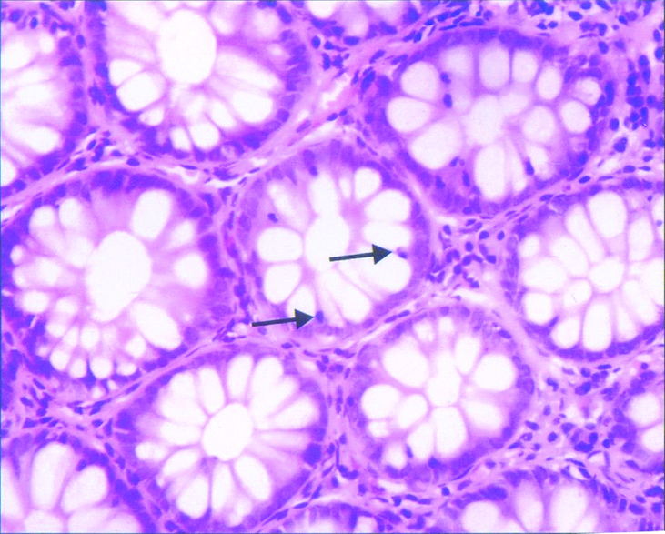 Comparison of intra epithelial lymphocyte counts in controls and ...