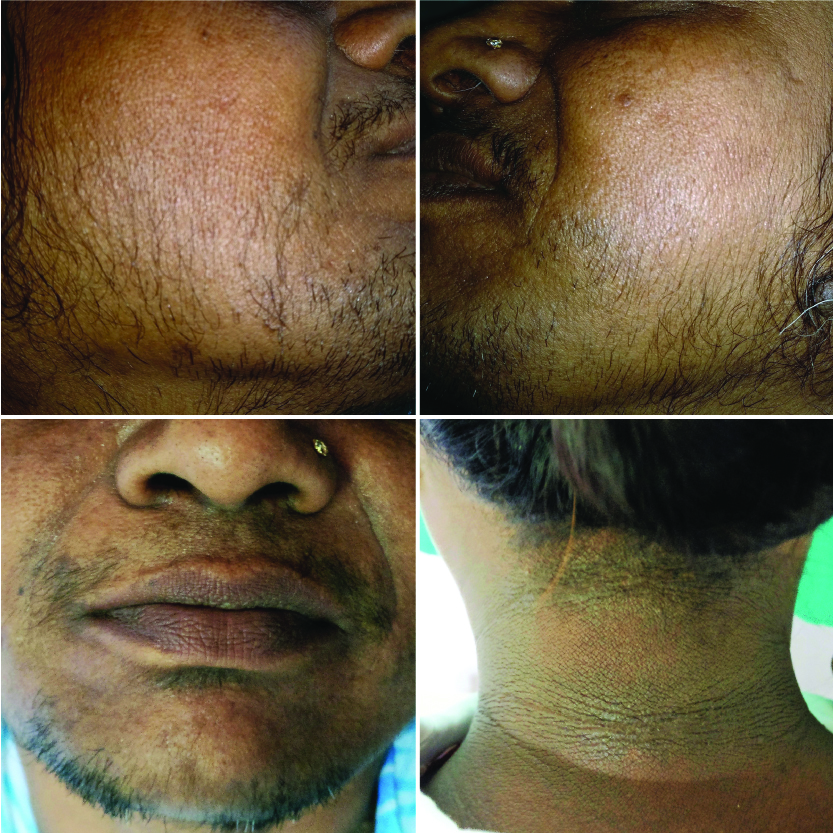 Mild Hirsutism