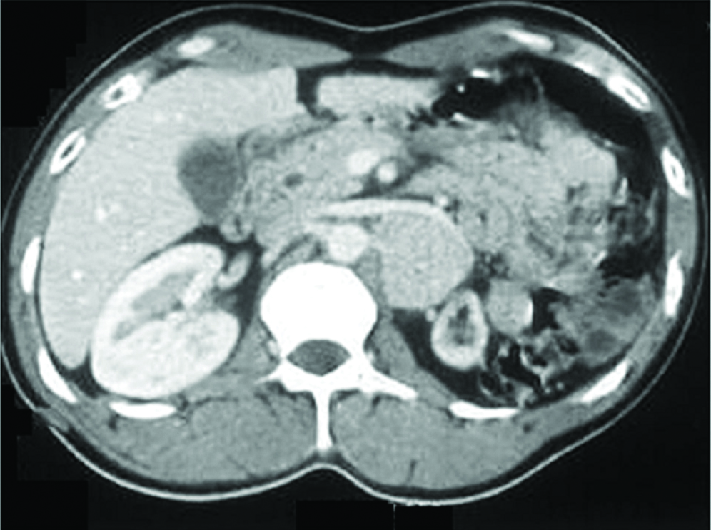 Gross-left nephrectomy specimen measuring 4×2×2 cm with attached ...