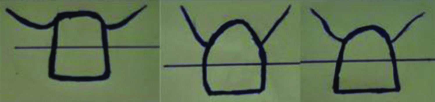 Classification of tooth forms based on Leon Williams method [ 8 ]: a ...