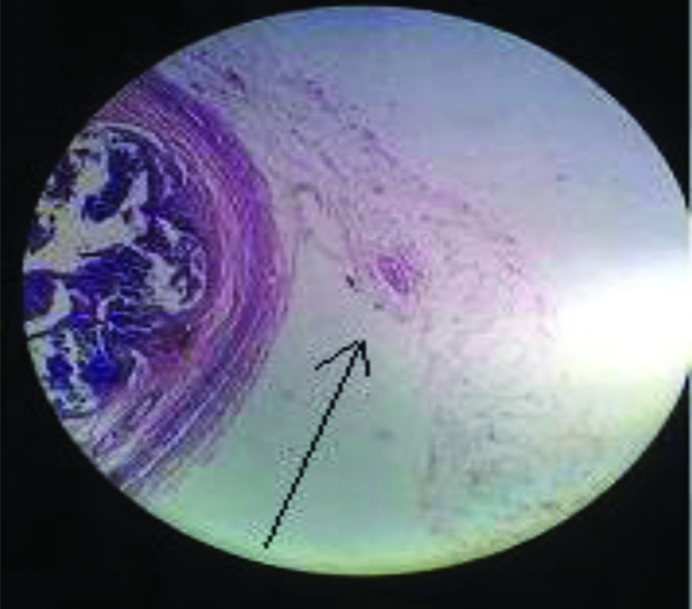 Appendices Epiploicae