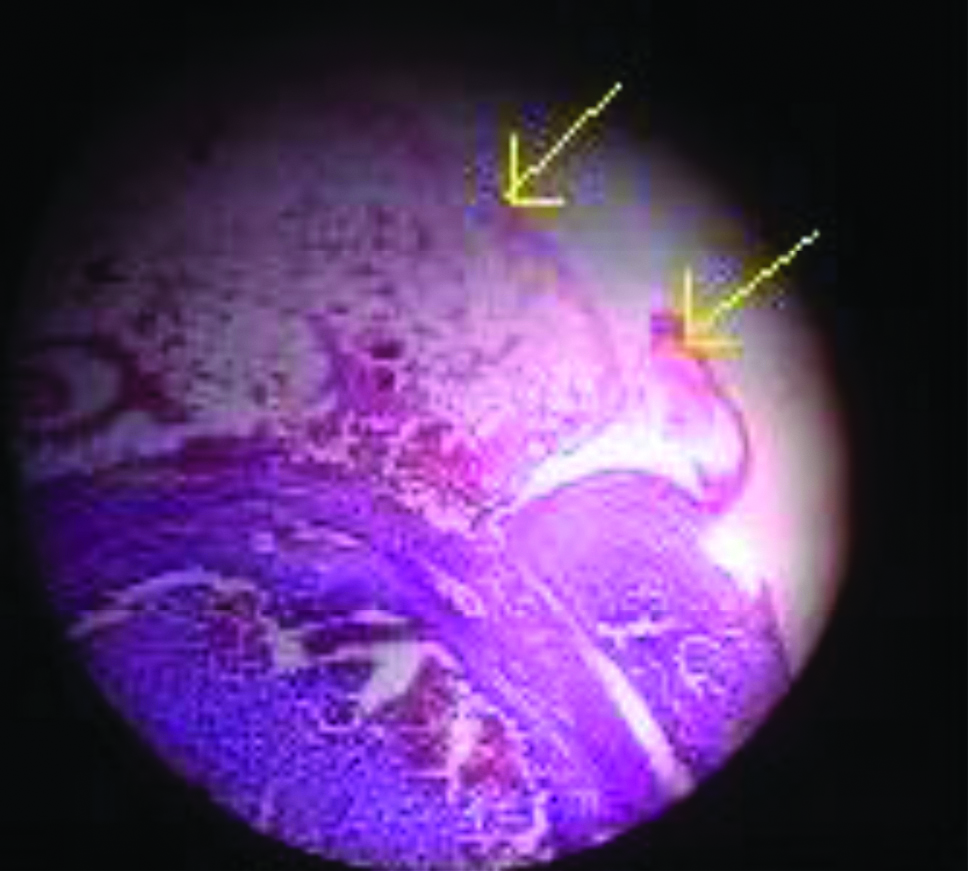 Appendices Epiploicae