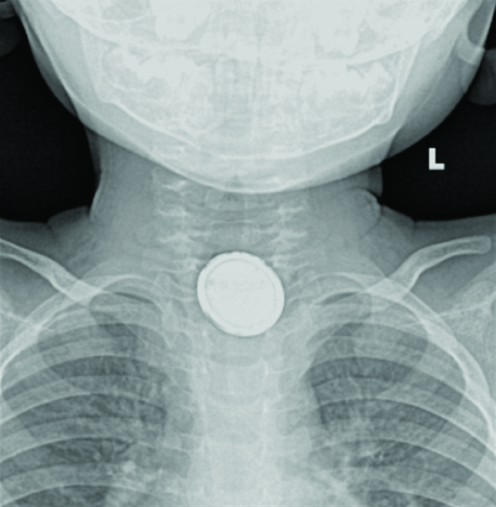 The 20 mm Lithium button battery that was removed from the cricopharynx ...
