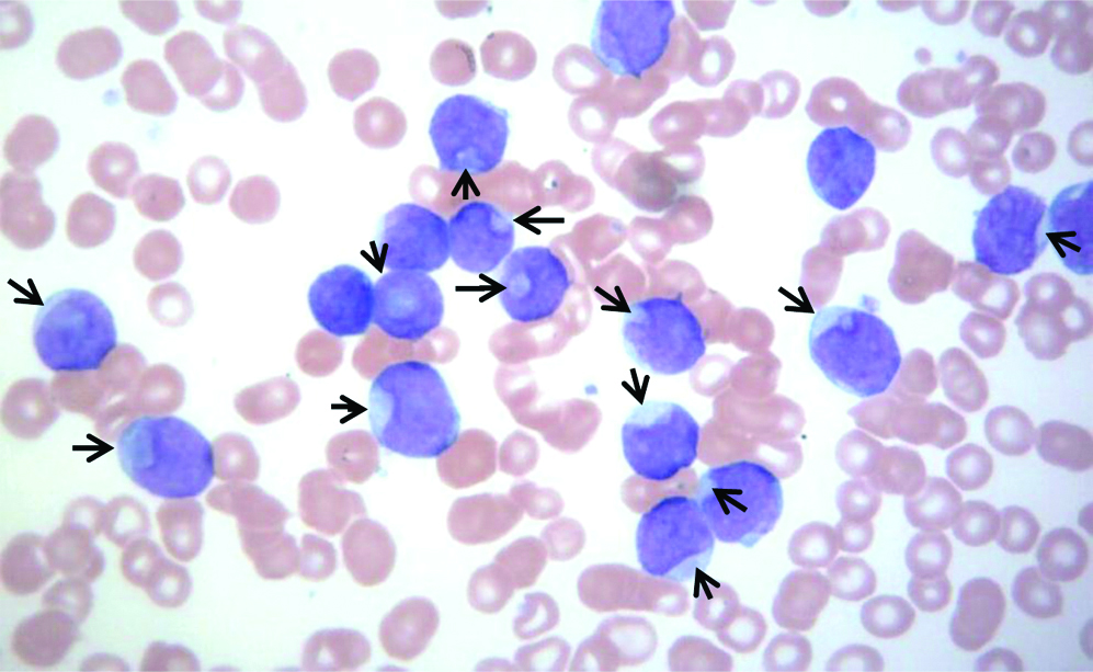Blast Peripheral Blood