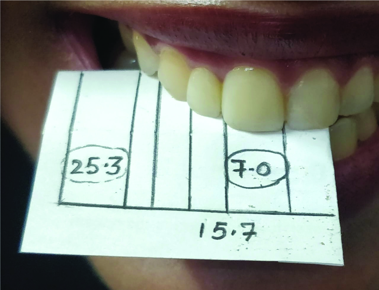Illustration of golden ratio in anterior teeth.