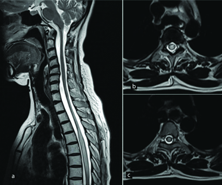 Acute Disseminated Encephalomyelopathy (ADEM)